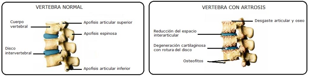 Artrosis cervical - Columna Vertebral