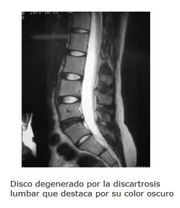 Que es discartrosis lumbar. Síntomas y tratamientos - Columna Vertebral